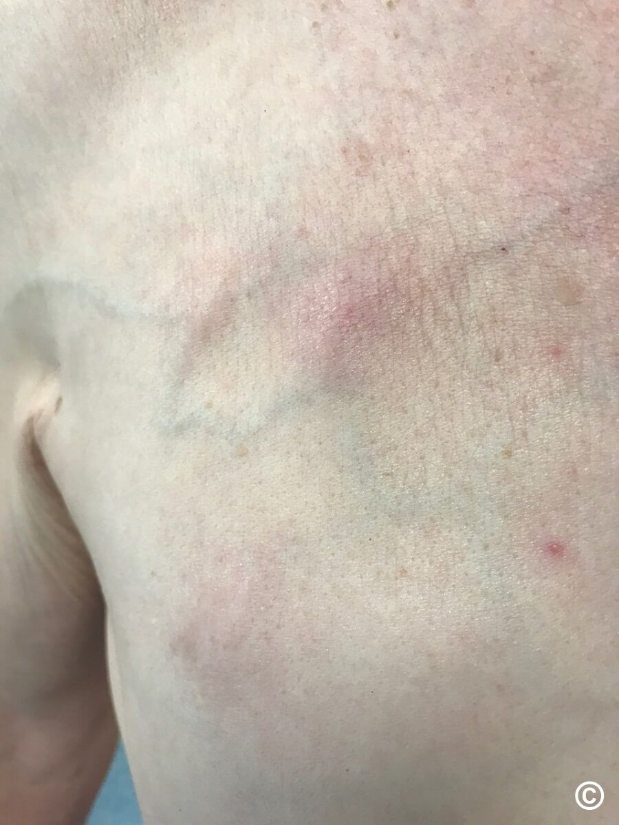 Butterfly Rash On Chest