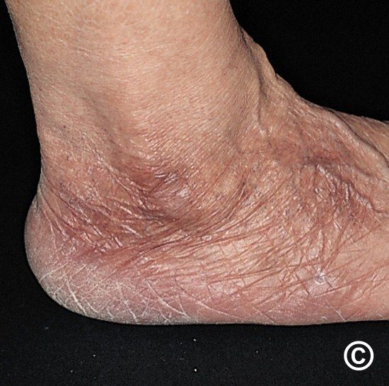 Acrodermatitis Chronica Atrophicans