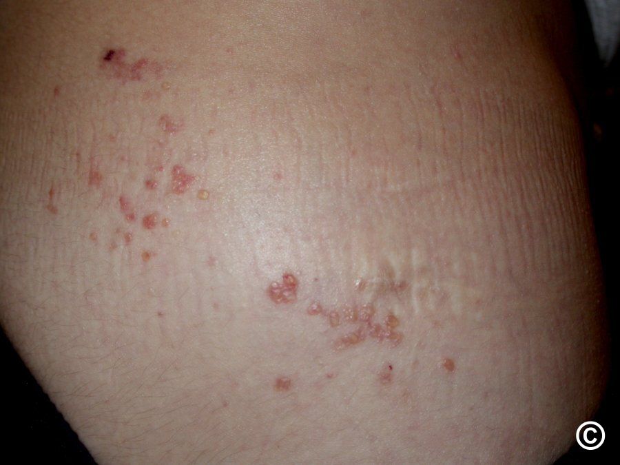 Cavernous Lymphangioma