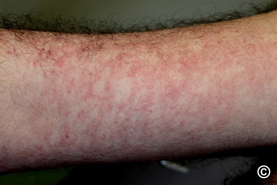 Papules Lymphoma