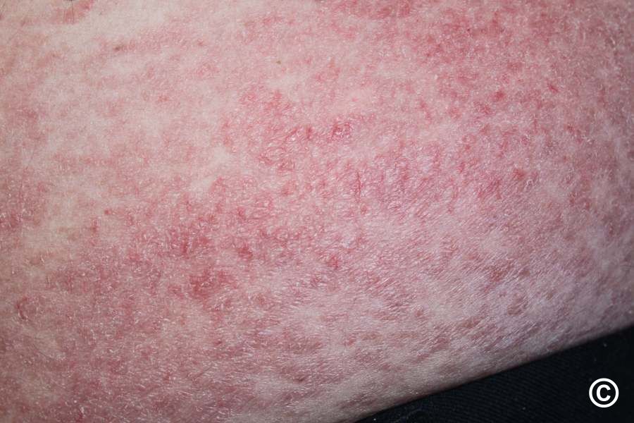 Poikiloderma atrophicans vasculare