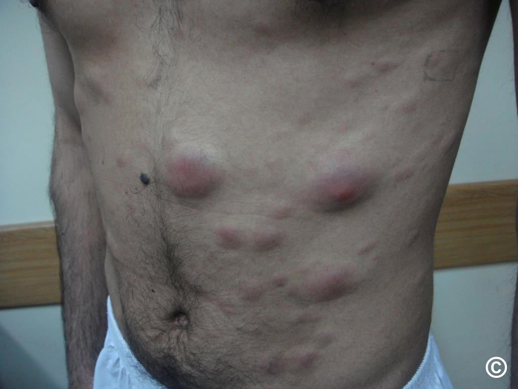 Lymphoma and leukaemia - cutaneous presentations