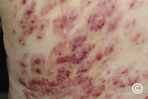 Lymphoma and leukaemia - cutaneous presentations
