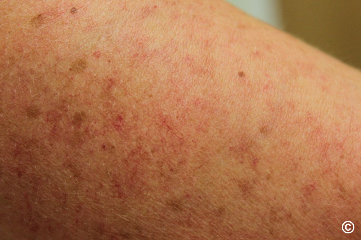 Telangiectasia Macularis Eruptiva Perstans Histology