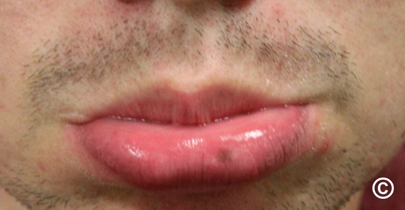 Mucosal melanocytic macules