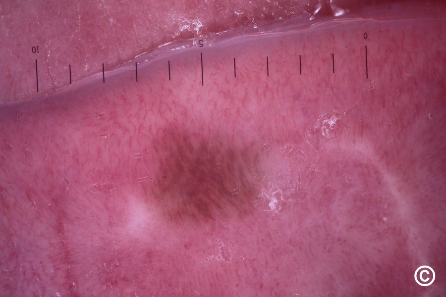 Mucosal melanocytic macules