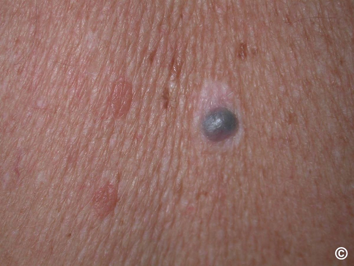 Nodular Malignant Melanoma Skin Lesions