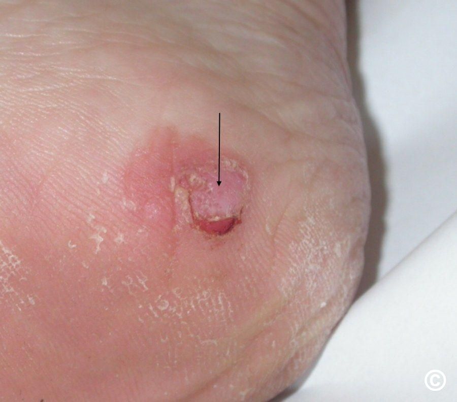 Superficial Spreading Melanoma Foot