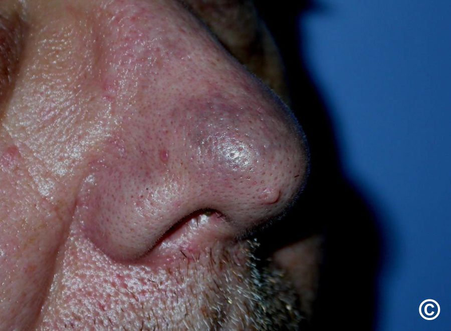 Hyperpigmentation - of the face and neck