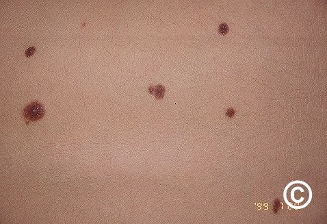 Congenital Melanocytic Nevus Compound Type