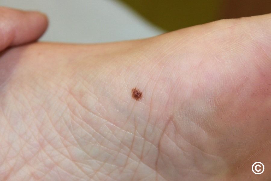 Junctional Nevus Foot