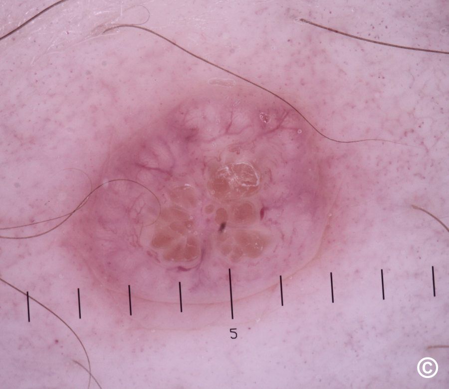 Molluscum contagiosum