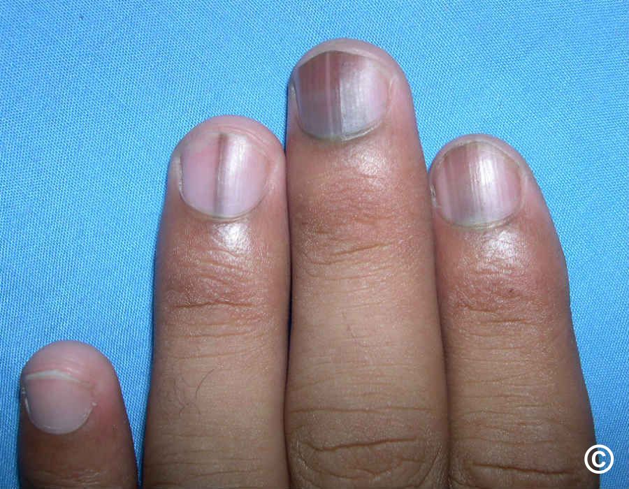 Nail disorders