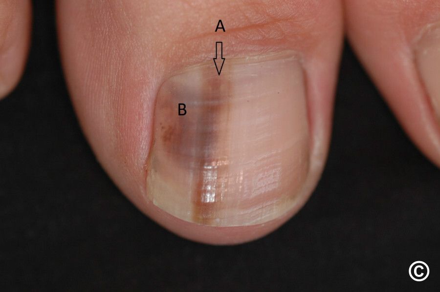 Nail disorders