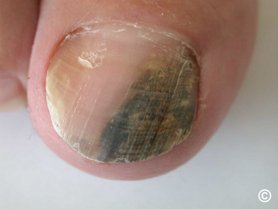 Nail disorders