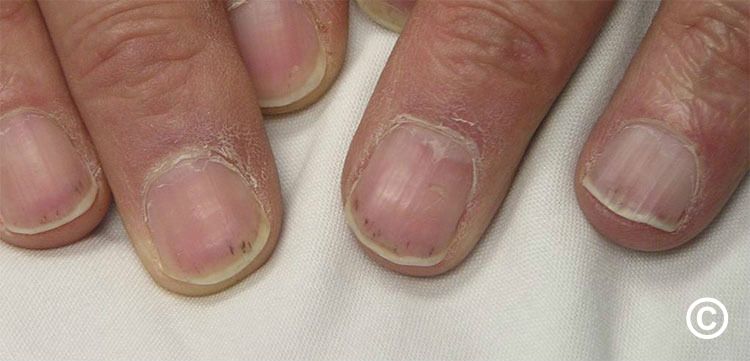 Nail disorders
