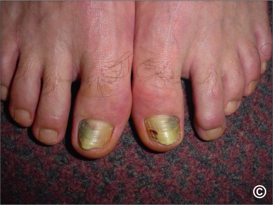 Nail disorders
