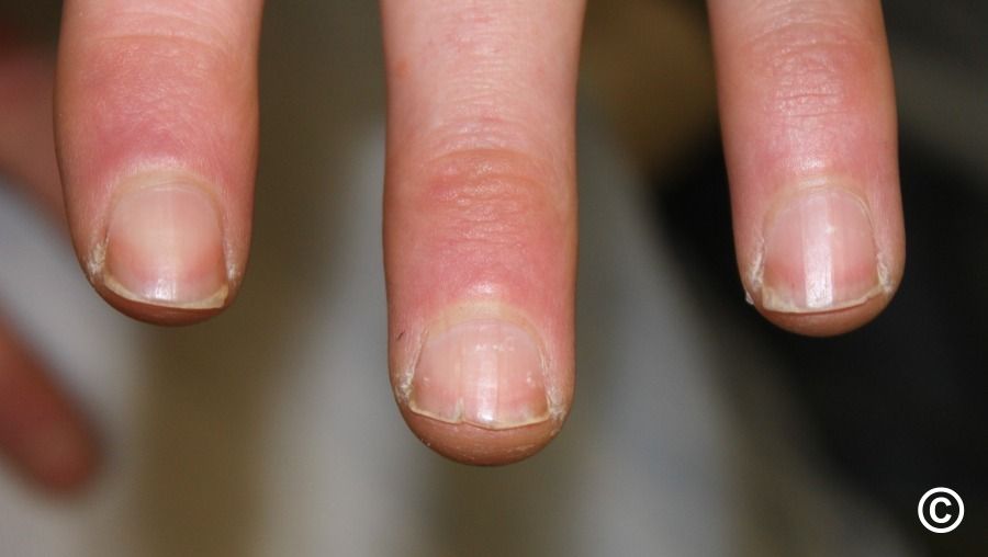Nail disorders