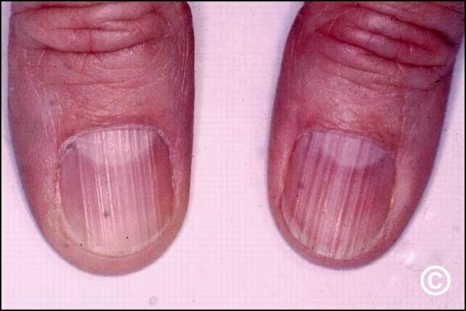 Nail disorders