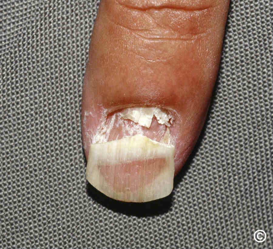 Nail disorders