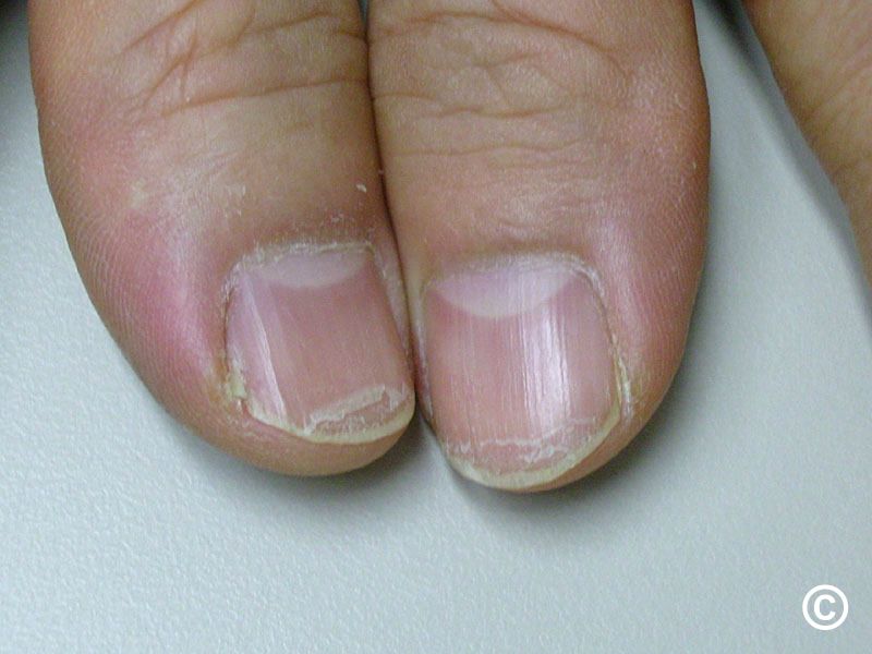 Lamellar nail dystrophy