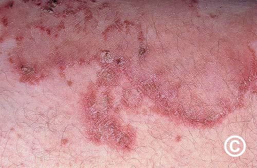Necrolytic Migratory Erythema The Characteristic Rash Associated With