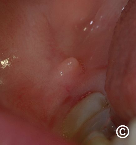 orofacial granulomatosis lips