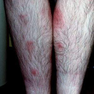 Panniculitis
