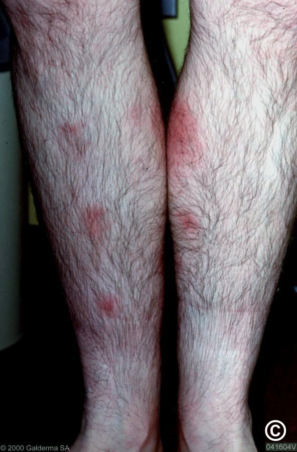 Panniculitis Infection