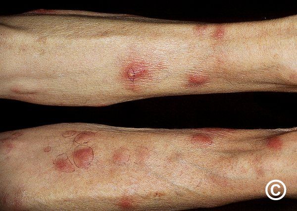 Panniculitis Infection