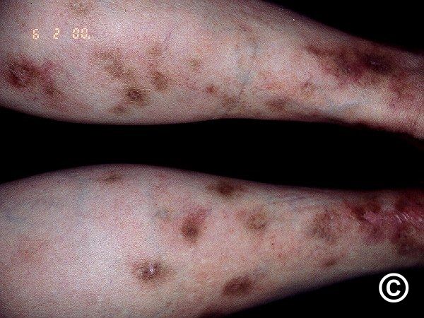 Erythema Induratum Panniculitis