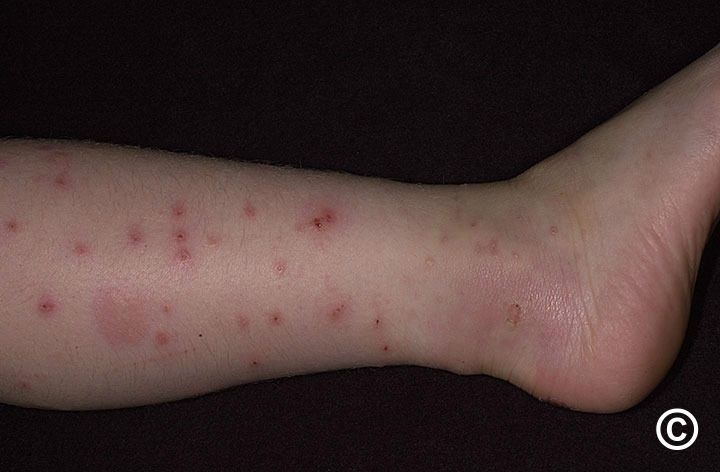 How do you get rid of papular urticaria