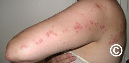 Flea Bite Allergic Reaction