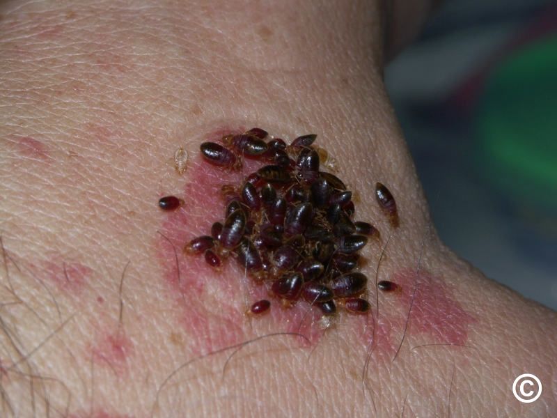 Papular urticaria