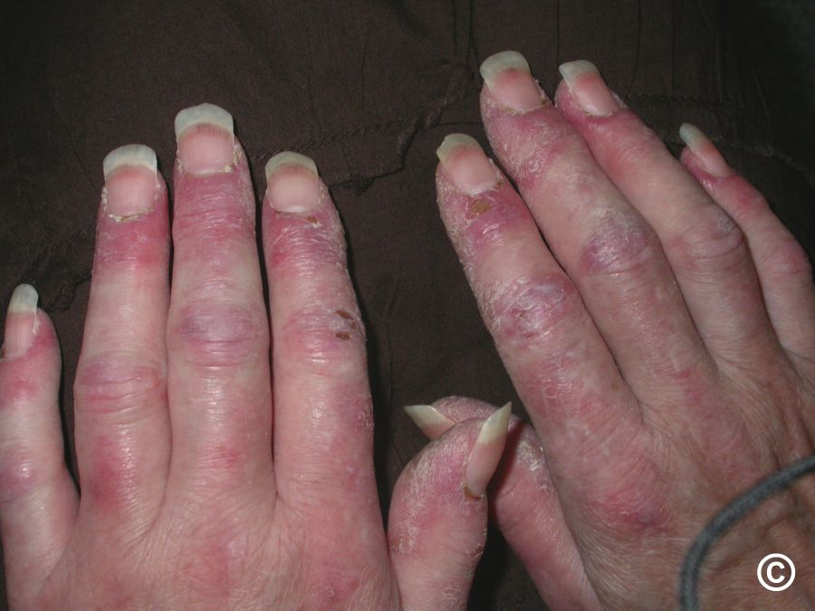 Dermatomyositis Paraneoplastic Syndrome