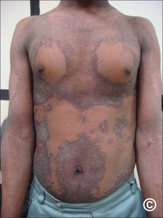 Skin Peeling Under Armpits