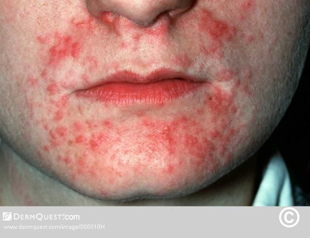 Perioral Dermatitis In Children