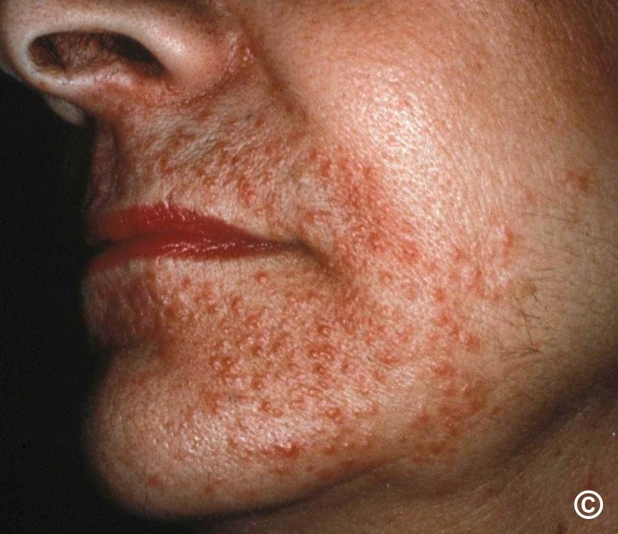 Perioral dermatitis