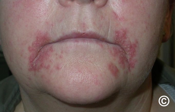 Perioral Dermatitis Eyes