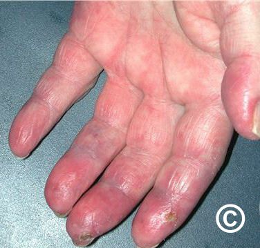 Lupus Pernio Hands