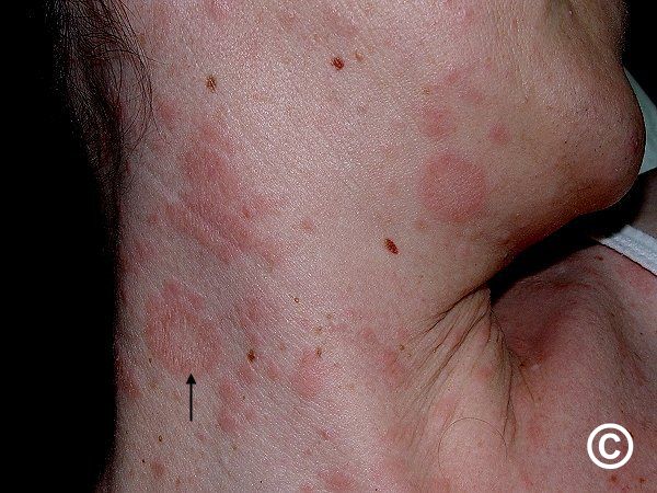 Pityriasis Rosea Face Pityriasis Rosea Cutis Dermatology