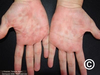 Rosacea On Hands