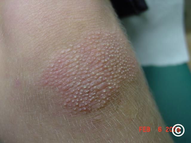 Pityriasis rubra pilaris