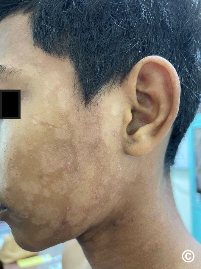 Pityriasis versicolor