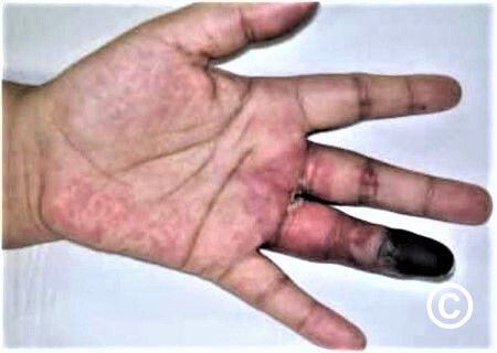 Polyarteritis nodosa