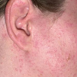 Polymorphic light eruption & juvenile spring eruption