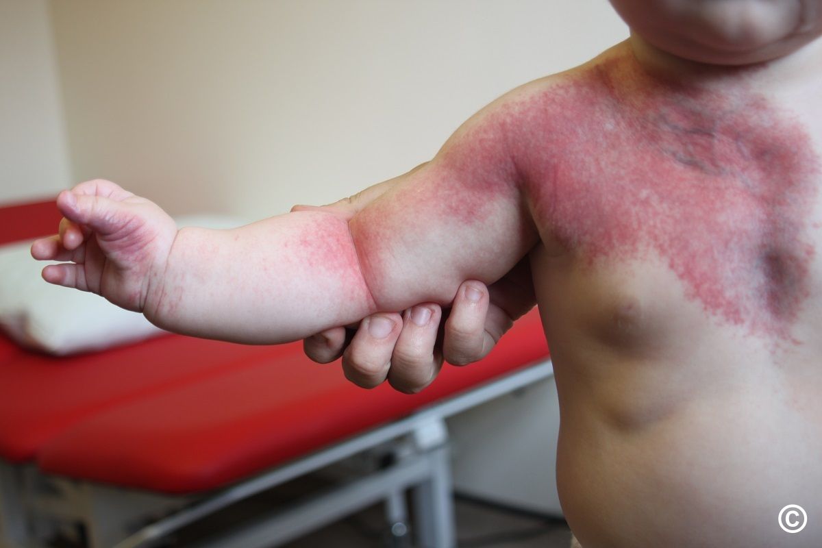 Port Wine Stain Meaning – Port Wine Stain Symptoms – UIEB