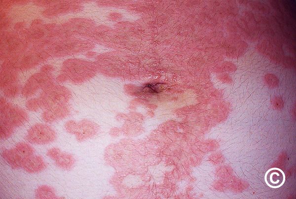 Pemphigoid gestationis