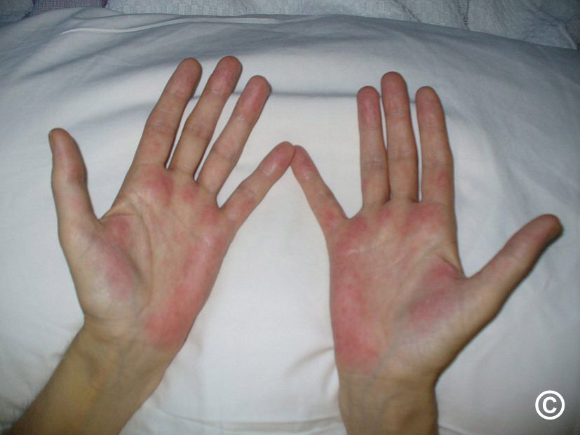 Eczema On Knuckles Pregnancy