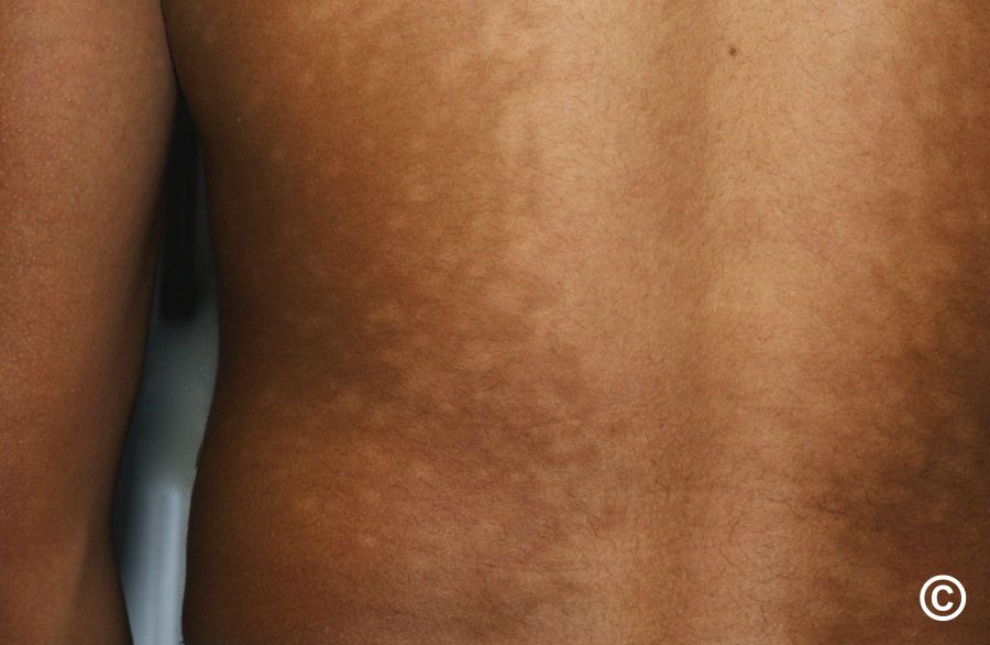 Progressive Macular Hypomelanosis Treatment